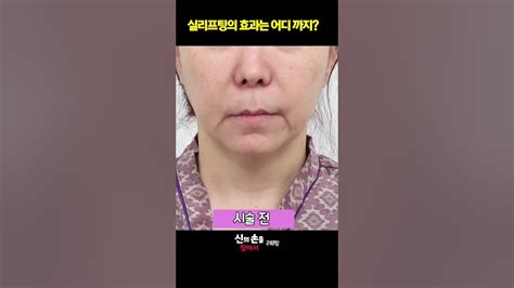 실리프팅의 효과는 어디까지 실리프팅실리프팅효과박수연원장 Liftingps Youtube