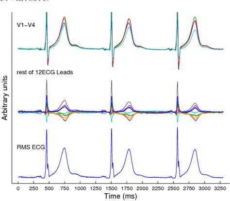 Figure 1 From A Multilead Wavelet Based Ecg Delineator Based On The Rms Signal Semantic Scholar