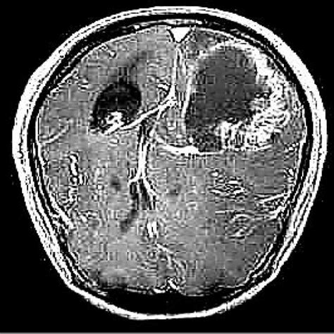 Tumor Classification Object Detection Dataset V Pm By Sri Venkateswara