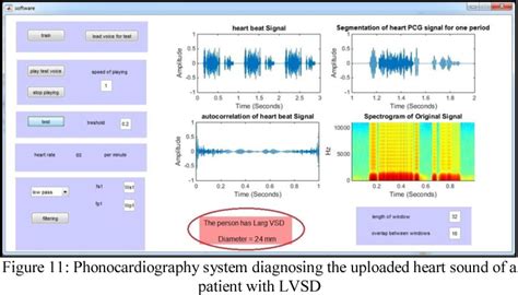 Figure 1 From Phonocardiography Signal Processing For Automatic Diagnosis Of Ventricular Septal