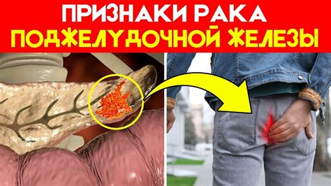 🚨ВНИМАНИЕ 10 симптомов РАКА ПОДЖЕЛУДОЧНОЙ ЖЕЛЕЗЫ которые ВАС ШОКИРУЮТ Youtube