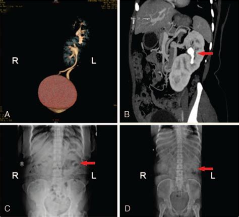 Crossed Fused Renal Ectopia With Renal Calculi Two Case Reports And A