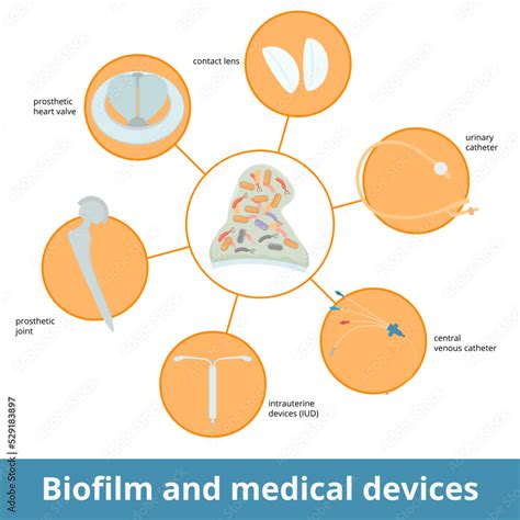 Biofilm And Medical Devices Common Sources Of Biofilm Growth And Development Including Contact