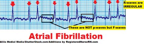 What Is The Difference Between Atrial Fibrillation A Fib Atrial