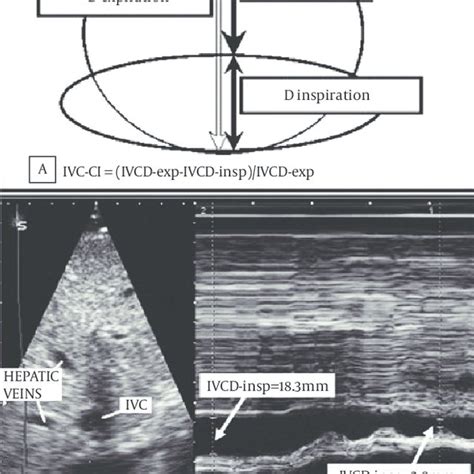 A Representation Of The Ivc Collapsibility Index Ivcci And B