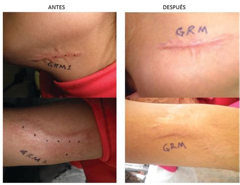 Cicatriz Hipertrofica Vs Queloide