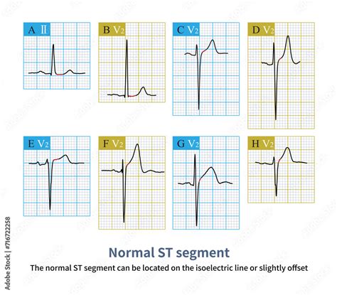 The Normal St Segment Can Be Located On The Isoelectric Line Or