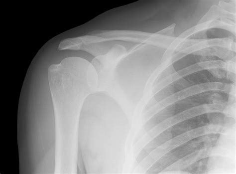 Normal Shoulder X Ray By Du Cane Medical Imaging Ltd