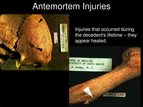 Ppt Forensic Anthropology Powerpoint Presentation Free Download Id