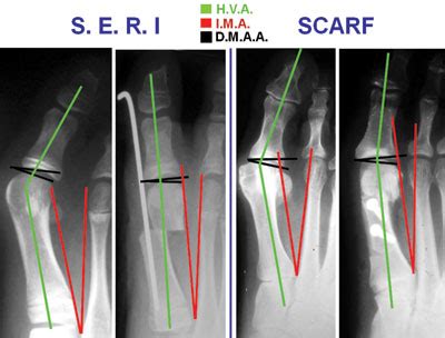 Scarf Osteotomy