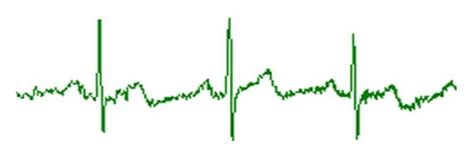 Eeg Contaminated By Cardiac Artifact Download Scientific Diagram