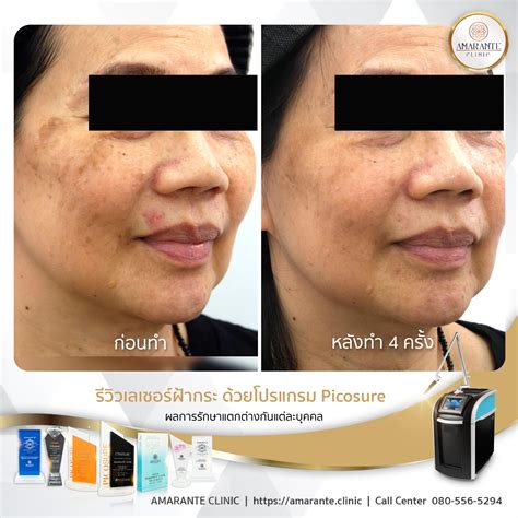 โปรแกรม Pico Laser มีกี่แบบ แต่ละยี่ห้อ แตกต่างกันอย่างไร