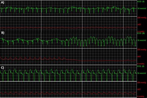 A The Initial Strip Shows Evidence Of Narrow Complex Tachycardia With Download Scientific