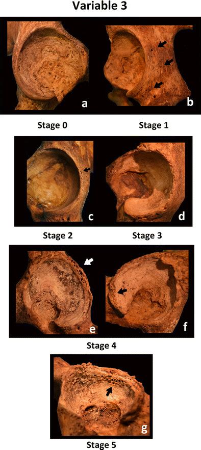 Images Describing Variable 3 A Male 16 Years The Acetabular Rim Is
