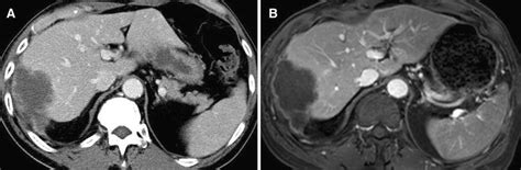 A 7 5 Cm Sarcomatous Intrahepatic Cholangiocarcinoma In A 57 Year Old Download Scientific