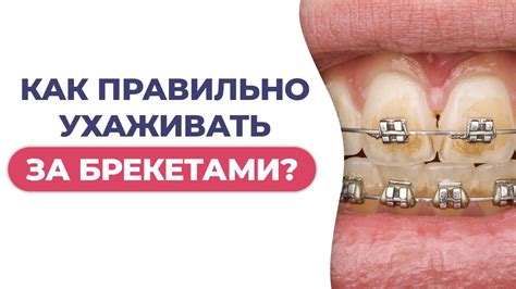 Как чистить зубы с брекетами ПРАВИЛЬНО Уход за брекетами и элайнерами дома Youtube