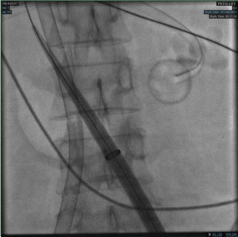 Advancing The Micra Sheath Over A Wire Past The Ecmo Cannula Into The Download Scientific