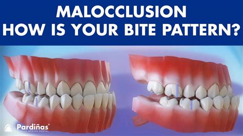 Malocclusion Bite Patterns © Youtube