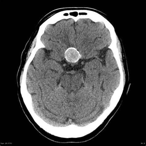 Case Of The Day Brain Mass On Ct Radrounds Radiology Network