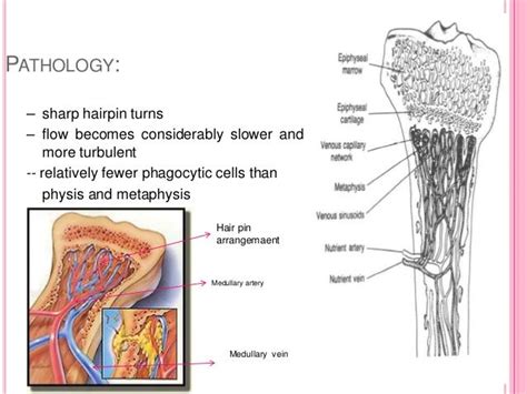 Osteomyelitis