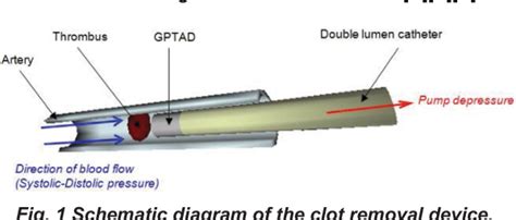 Figure 1 From Analysis And Design Of A Thrombectomy Device By Using Simulation Techniques