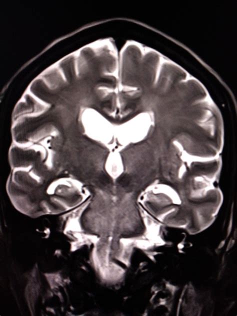 Osmotic Demyelination Syndrome Radiology Imaging Neurology Radiology