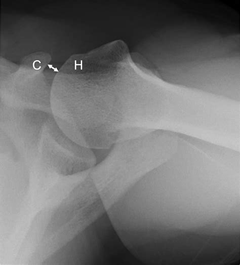 Subcoracoid Impingement In A Dragon Boat Racer American Journal Of Physical Medicine