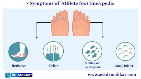 Athlete Foot Tinea Pedis Ringworm Of Feet Best Homeopathic