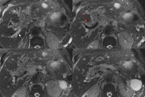Cholangiocarcinoma Body Mri