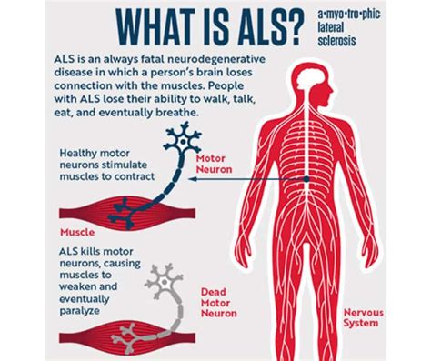 Als Diagram Als Arizona