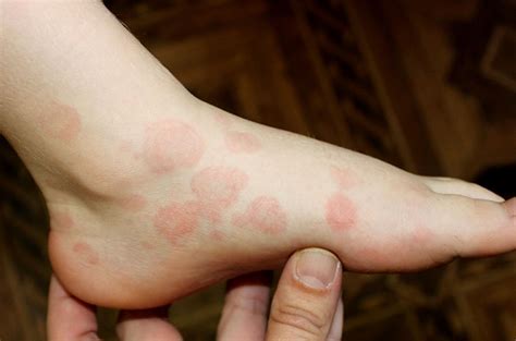 Komplikasi Kesehatan Yang Terjadi Akibat Eritema Multiformis