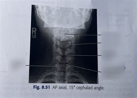 Anatomy Demonstrated Ap C Spine Diagram Quizlet
