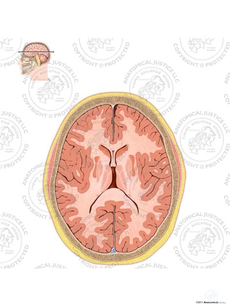 Edema Of The Brain Cross Section No Text
