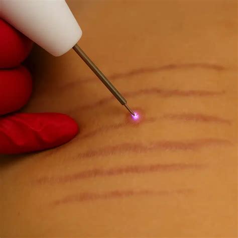 Striaefusionplasma Huidkliniek Derma Sensation