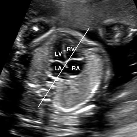 Fetal Cardiac Us Techniques And Normal Anatomy Correlated With Adult