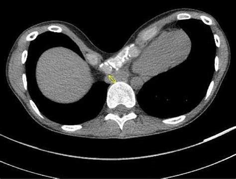 Computerized Tomographic Scan Of A Patient With Severe Pectus Excavatum