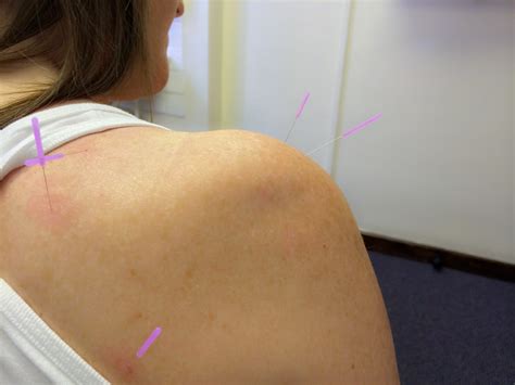 Asad And Acj Excision For My Poorly Shoulder Priceless Life Of Mine