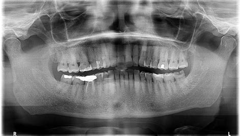 Dentistry Object Detection Dataset V Pm By Nanyang Technological University