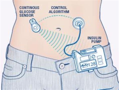 Figure 1 From Fuzzy Model Predictive Controller For Artificial Pancreas