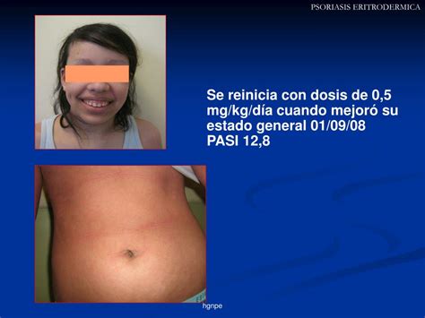 Ppt Psoriasis Eritrod É Rmica Erythrodermic Psoriasis Powerpoint