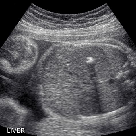 Antenatal Hepatic Calcification Image