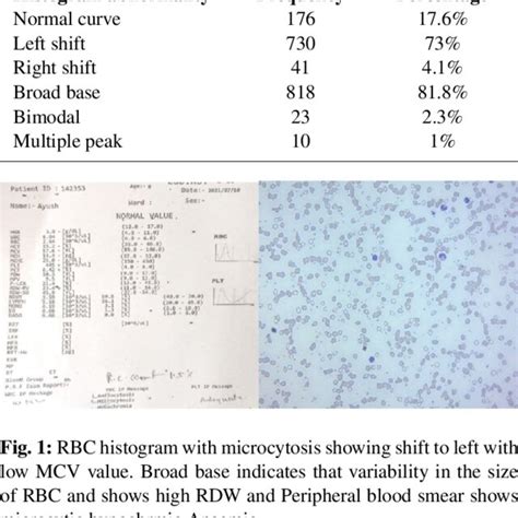 The Rbc Histogram Shows Macrocytosis With A Shift To The Right And A