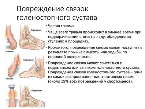 Растяжение связок голеностопного сустава, лечение в домашних условиях