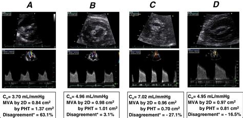 Impact Of Cardiac Rhythm On Mitral Valve Area Calculated By The