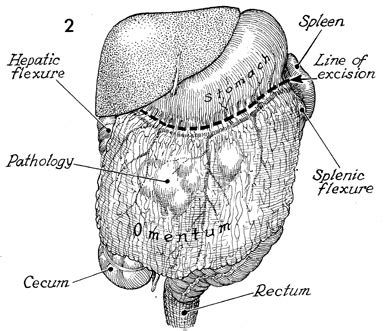 Supracolic Total Omentectomy