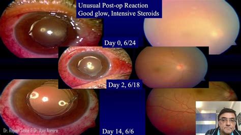 Toxic Anterior Segment Syndrome Tass All You Wanted To Know Youtube