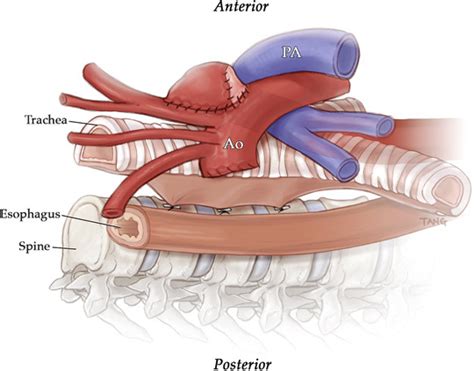 Aortic Uncrossing And Tracheobronchopexy Corrects Tracheal Compression