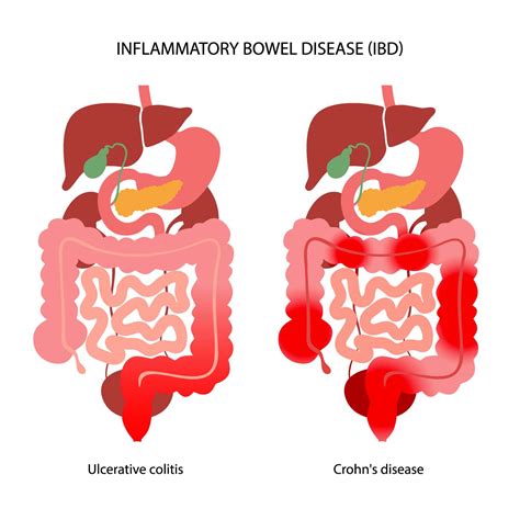 Ibd Treatment In Los Angeles Crohns And Colitis Relief Scmsc