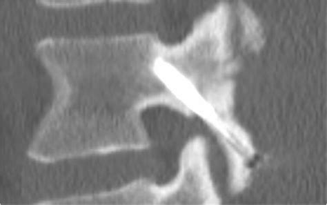 Four Month Postoperative Ct Scan Of Pars Repair Download Scientific Diagram