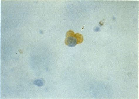 Reactivity Of Blastic Cells Case Ky With Mrk 20 Mab Abc Po Method X